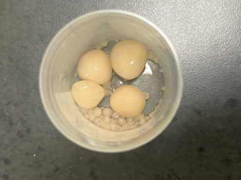 Bladder Stone Cause and Treatment